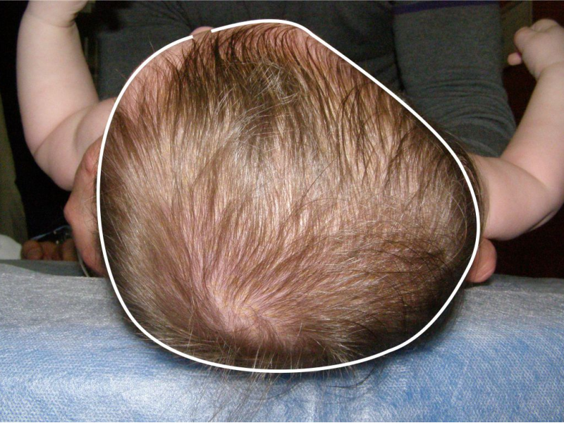 OSTEOPATIA e PLAGIOCEFALIA